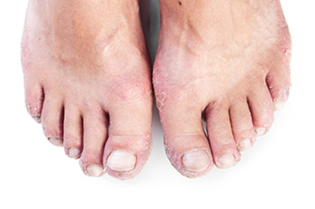Psoriatic Arthritis and Its Effects on the Feet